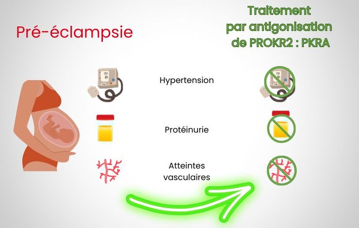 Fabrique de savoirs - Nouvelle piste thérapeutique pour la pré-éclampsie